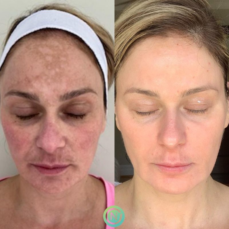 Cosmelan Peel - Transform Your Skin with Targeted Treatment