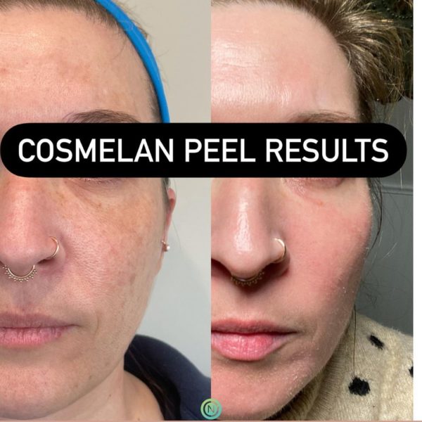 Cosmelan Peel - Transform Your Skin with Targeted Treatment
