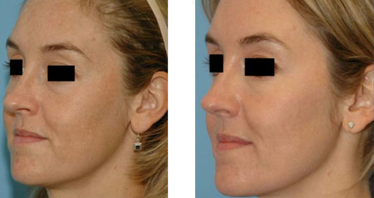 Phoenix CO2 Laser System | Novique Medical Aesthetics