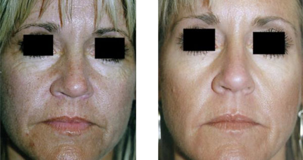 Phoenix CO2 Laser System | Novique Medical Aesthetics