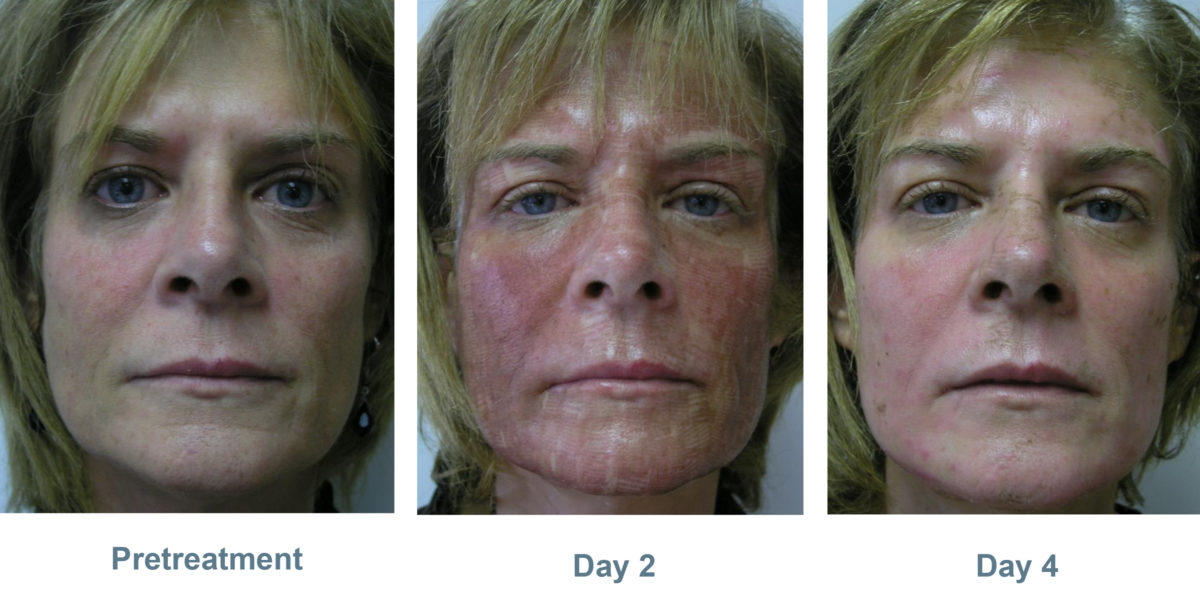 Phoenix CO2 Laser System | Novique Medical Aesthetics