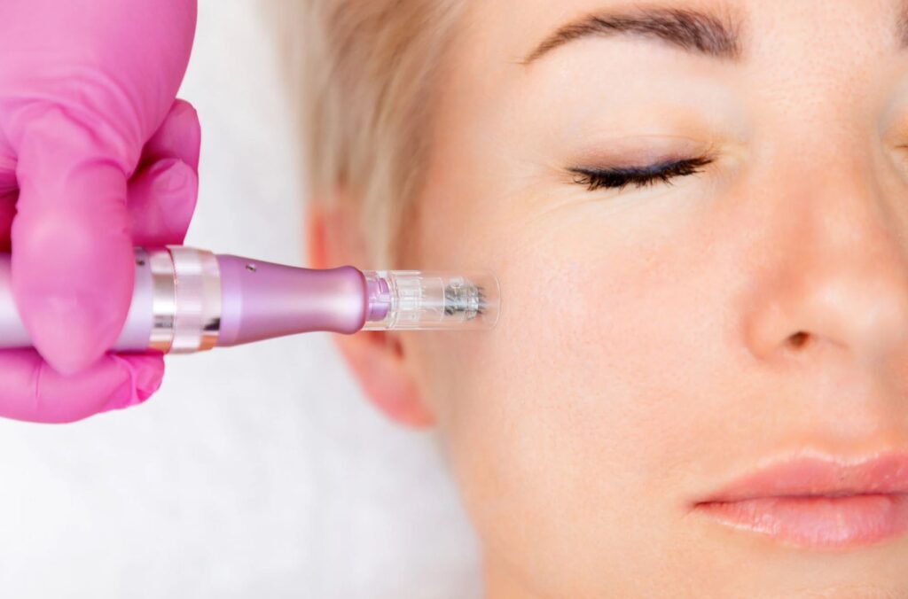 What Does Microneedling Do for Your Skin?