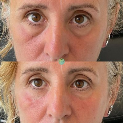 Botox® Doylestown Anti-Wrinkle Injection Bucks County PA 267-899-5020