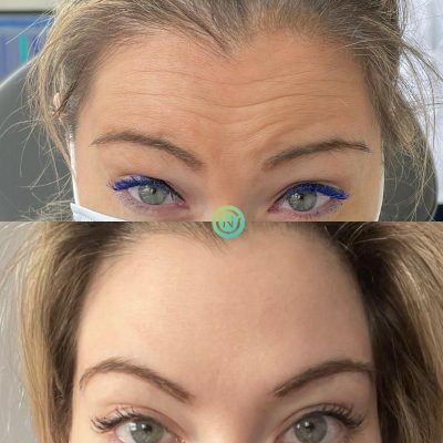 Botox® Doylestown Anti-Wrinkle Injection Bucks County PA 267-899-5020